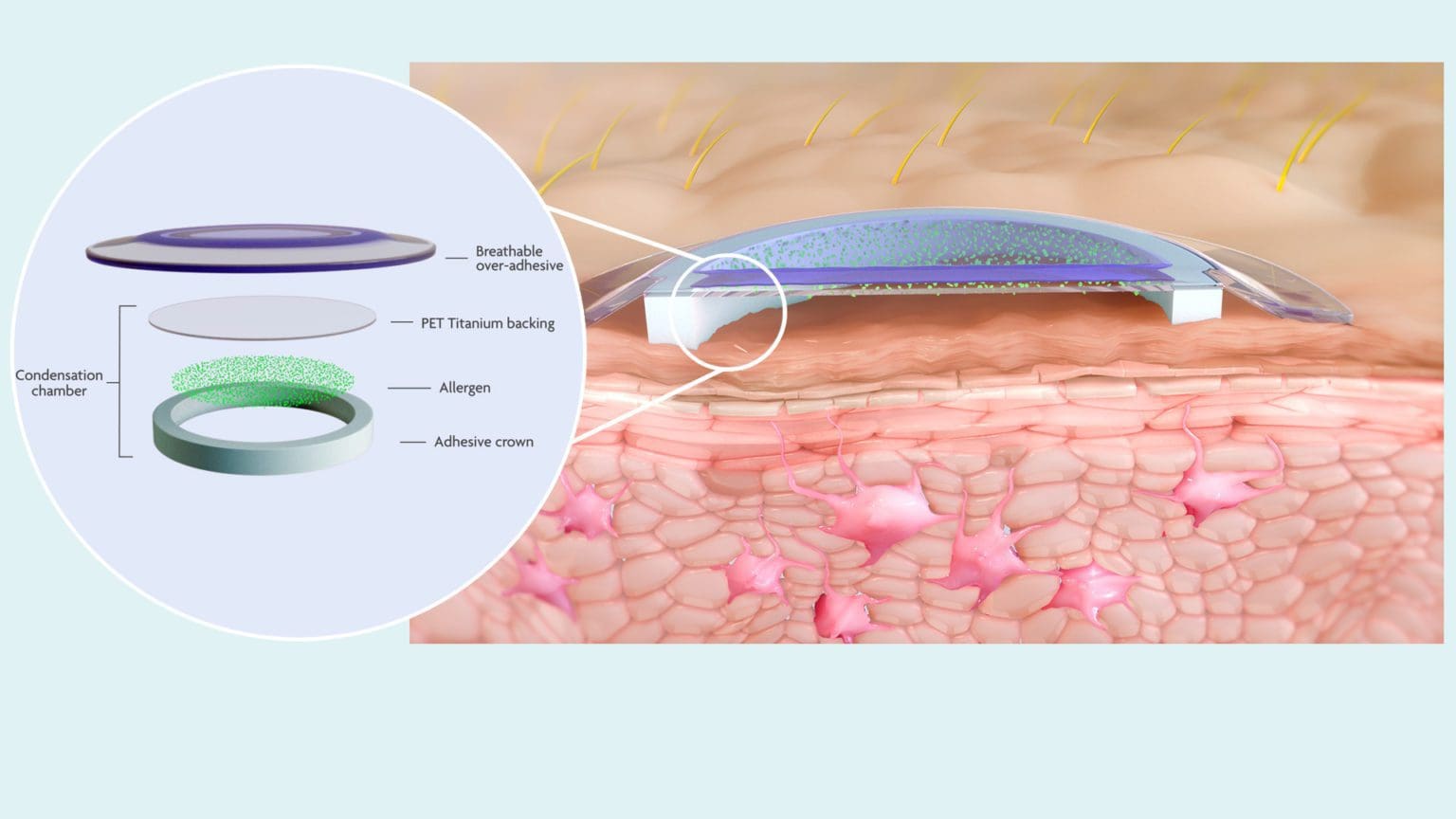 Viaskin Platform | DBV Technologies